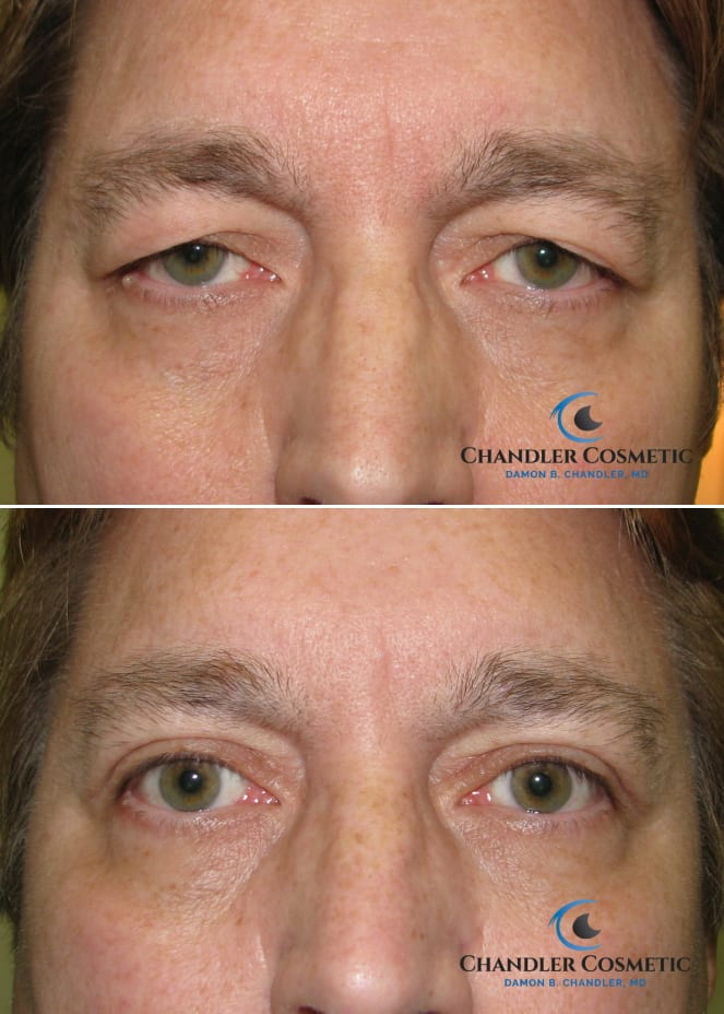 Cosmetic Surgery in Men Philadelphia | Chandler Cosmetic